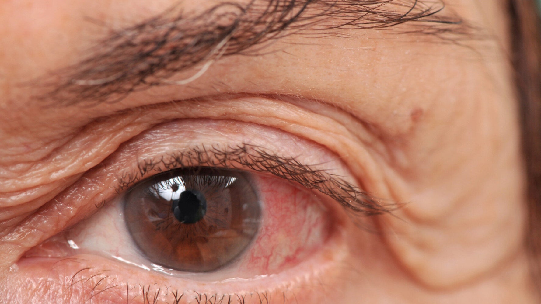 What Is Glaucoma? Symptoms, Causes And Treatment For The Eye Condition ... What Is Glaucoma? Symptoms, Causes And Treatment For The Eye Condition ...