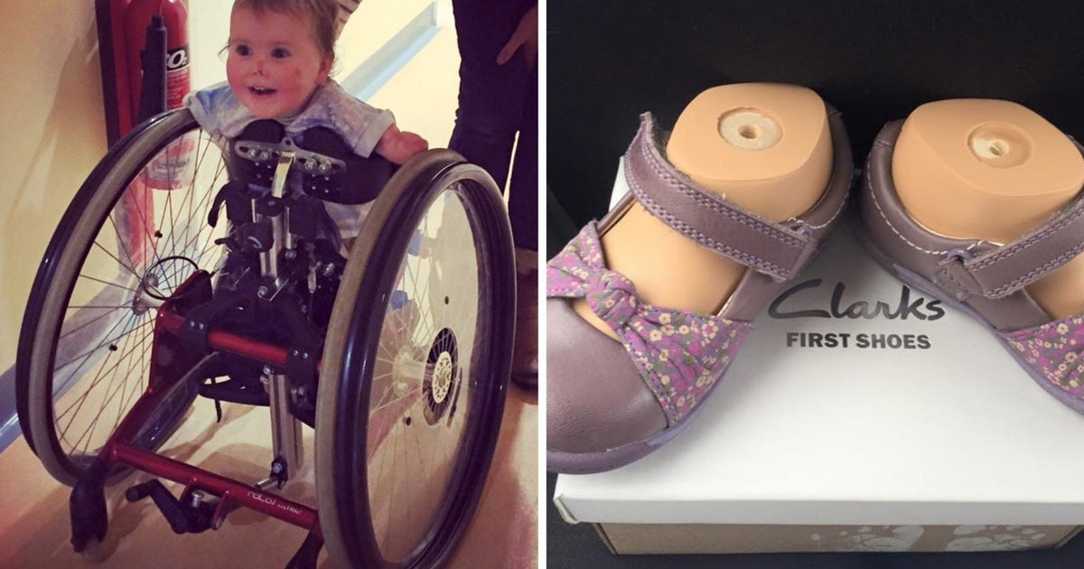 Toddler Who Lost Arms And Legs To Meningitis Learning To Walk With ...