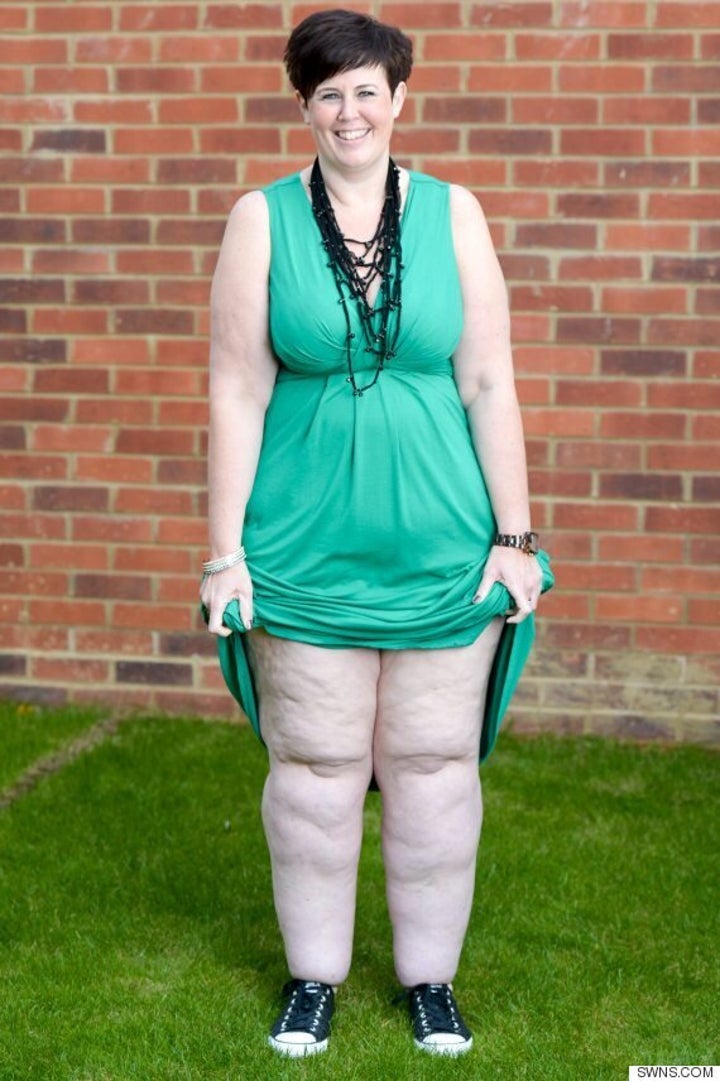 Fat Storing Condition Lipoedema Leaves Woman With 10 Stone Legs Fat Storing Condition Lipoedema Leaves Woman With 10 Stone Legs