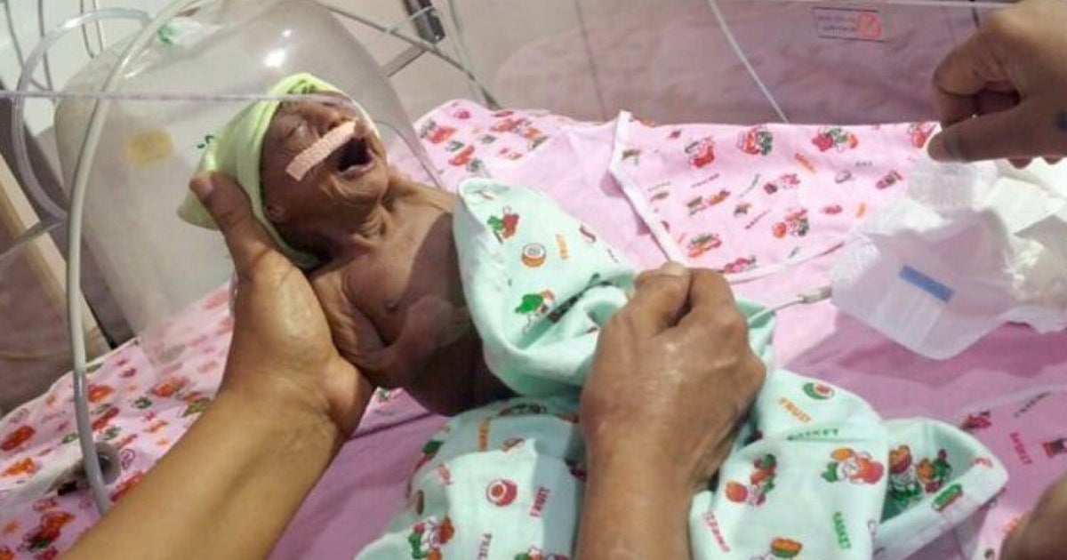 Newborn Baby Girl Abandoned By Parents Because Rare Condition Has Left ...