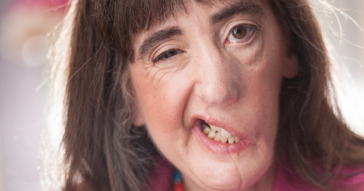 Woman Who Had Half Her Jaw Removed Due To Tumour Refuses Surgery: 'I ...