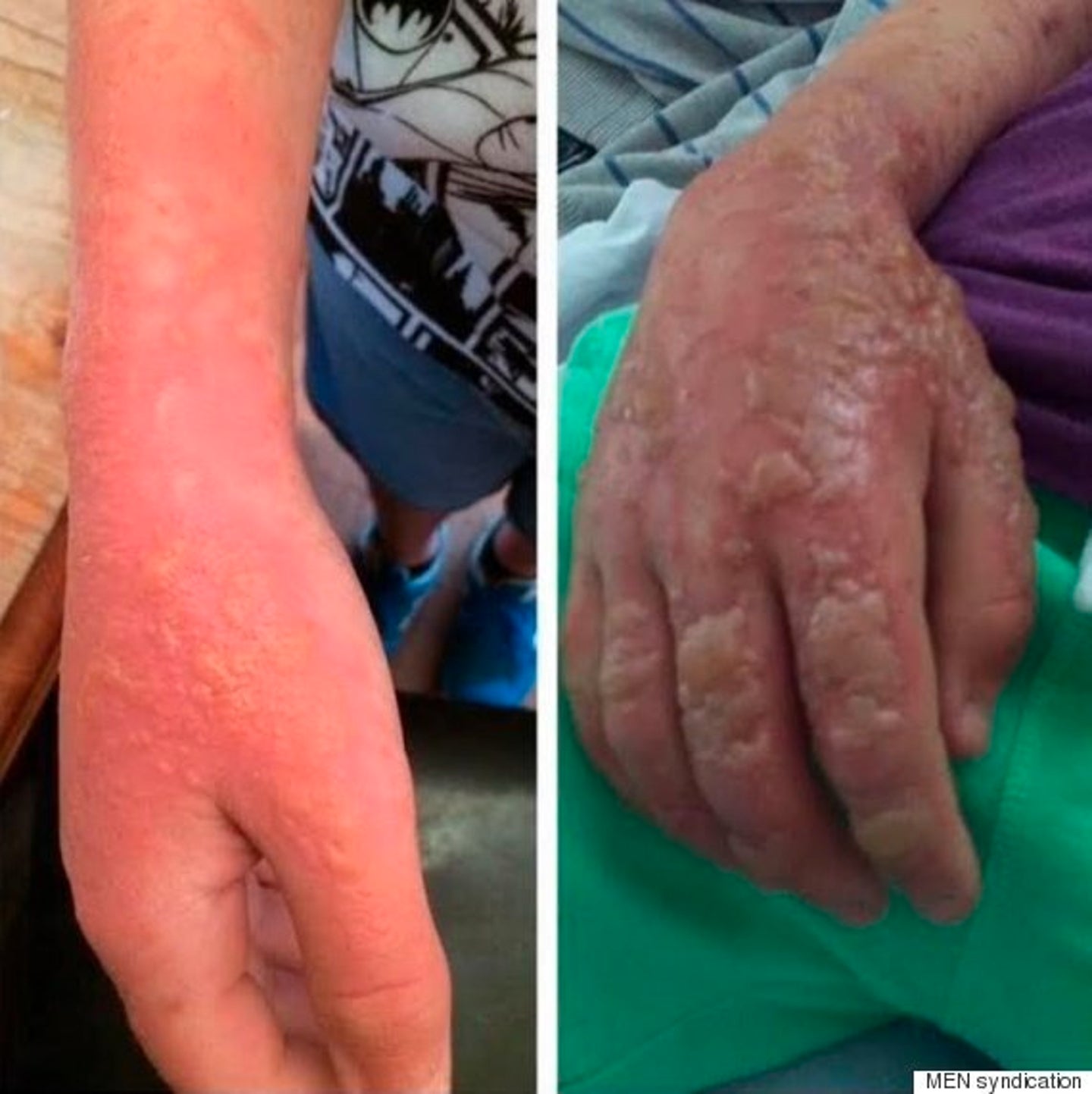 Giant Hogweed Plant Leaves Five Children With Severe Burns | HuffPost ...