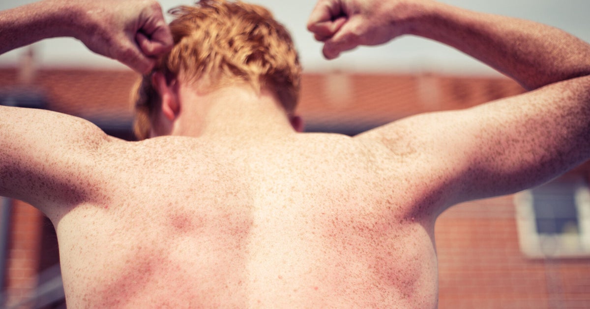 Eating Disorders Aren't Just A Women's Issue, Men Are Suffering Too ...