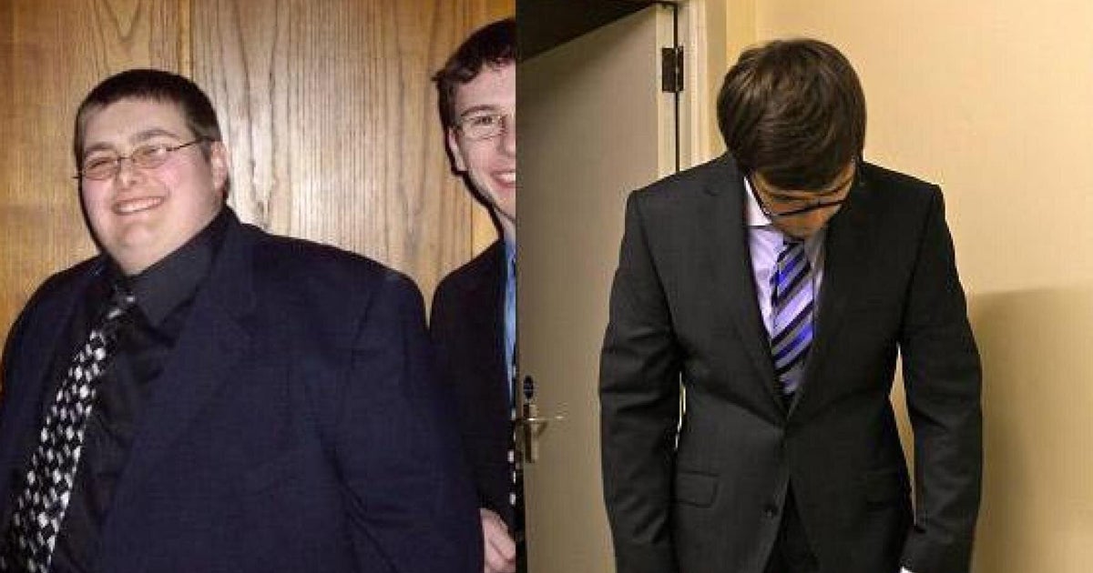 Excess Skin After Weight Loss: Man Loses 260Ibs, Then Shares Brave ...