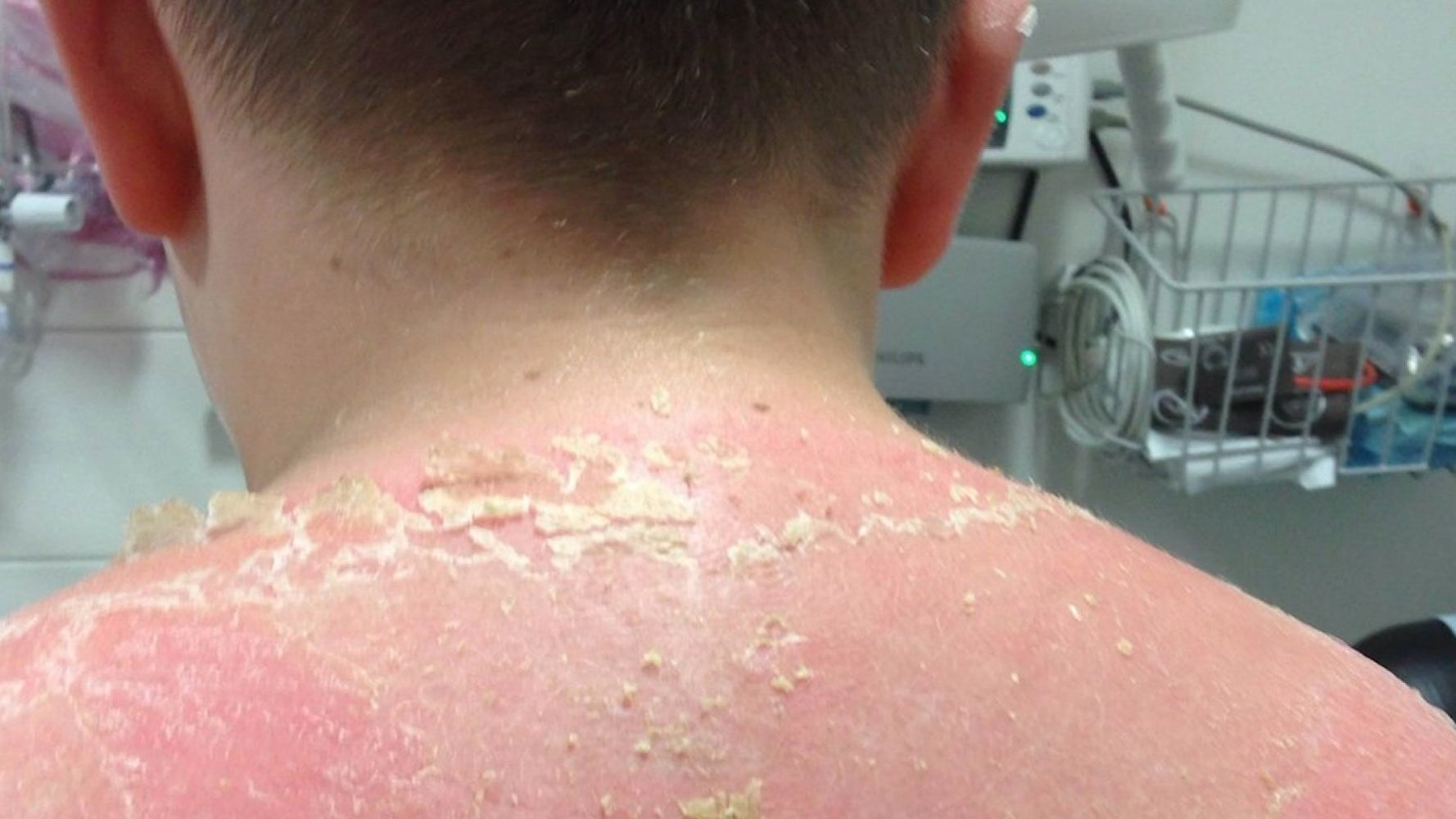 Mum Of Teen Who Suffered Severe Sunburn On School Trip Says Teachers Are Not To Blame Huffpost