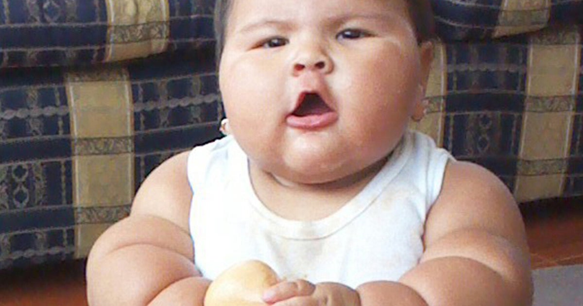 Obese Baby With Mystery Illness Weighs 20Kgs At Just 10 Months Old ...