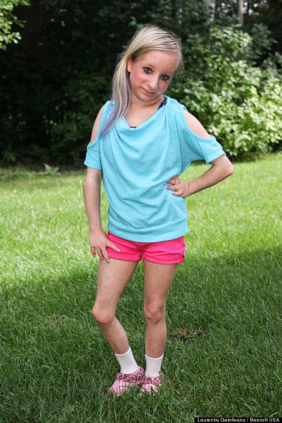 It Doesnt Mean Im Any Different Teen Born With Primordial Dwarfism
