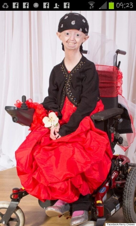 Hayley Okines, The '100-Year-Old Teeanger', Dies Aged 17 After ...