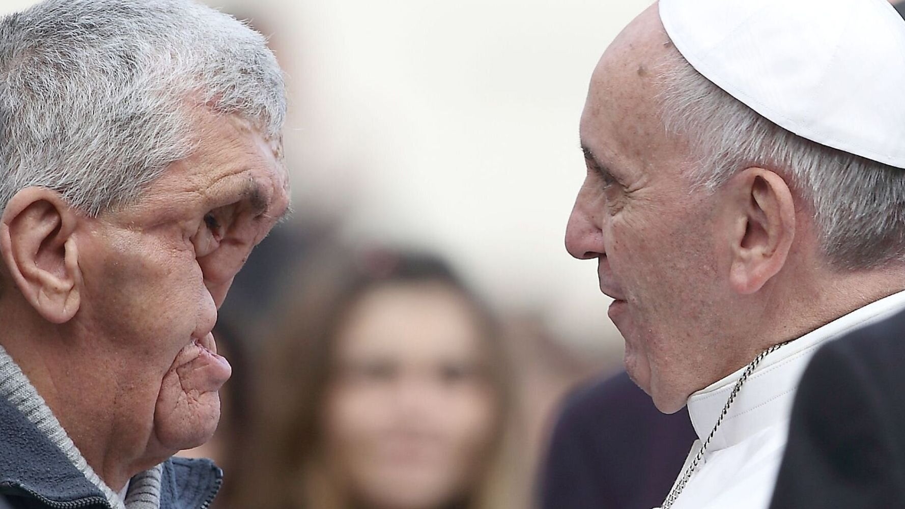 Pope Francis Blesses & Embraces Disfigured Man In St Peter's Square ...