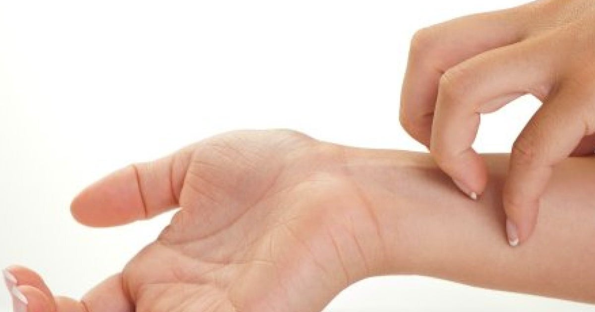 Eczema Could Reduce The Risk Of Skin Cancer, Research Shows | HuffPost ...