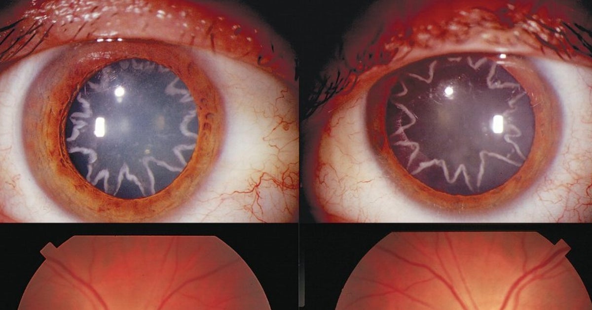 Man Left With Star-Shaped Cataracts After 14,000-Volt Electric Shock ...