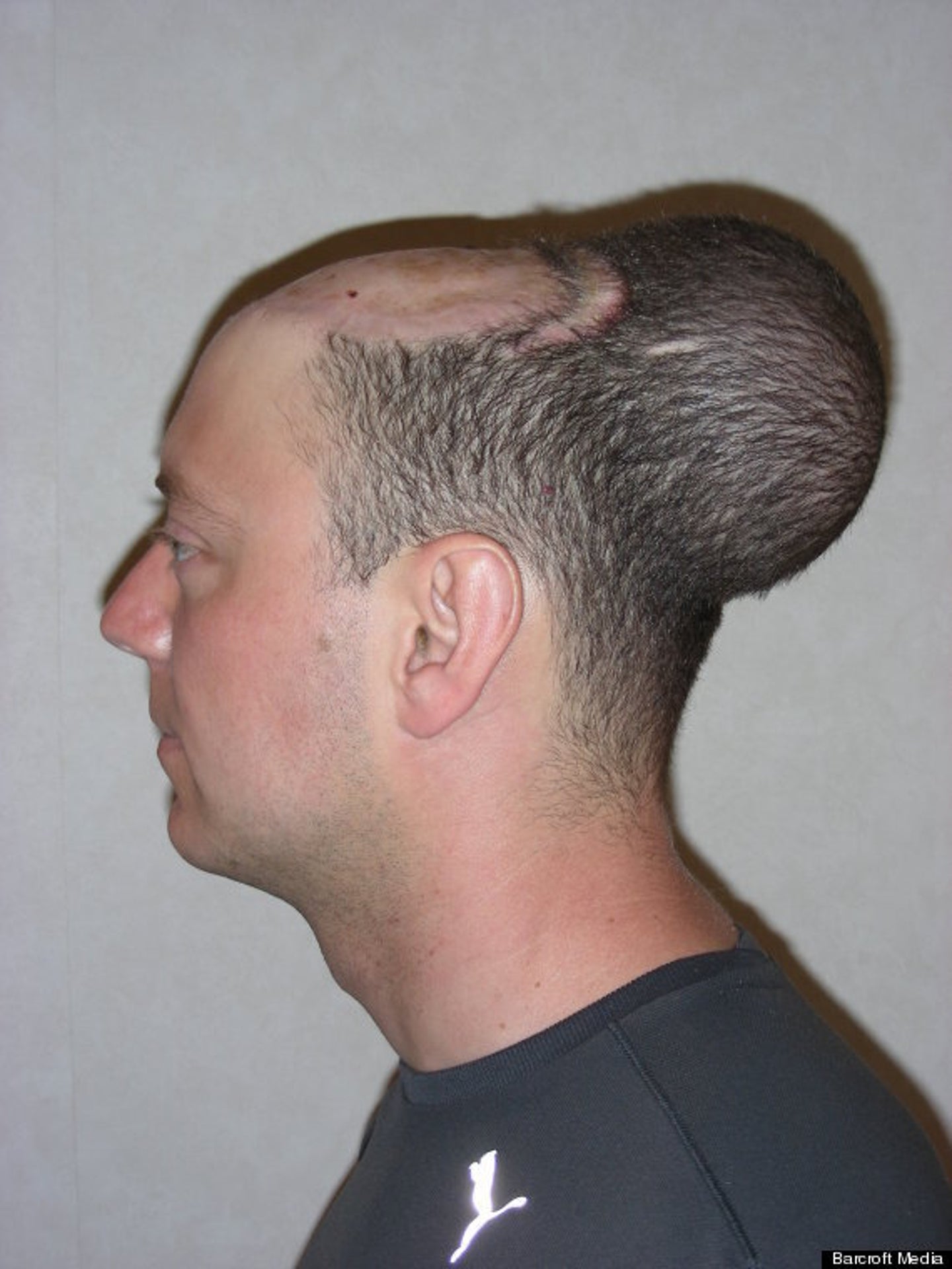 Man's Head Was Blown Up Like A Balloon For Six Months As Part Of ...