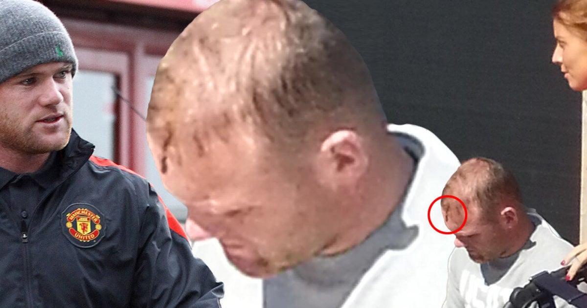 Wayne Rooney's Cut Head Revealed In First Pictures Of Wound (GRAPHIC ...