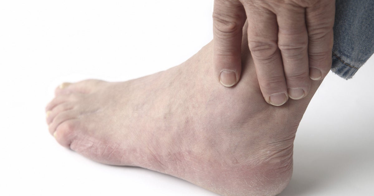 Gout, 'The Disease Of The Kings', Is On The Rise - Here's How To Spot ...