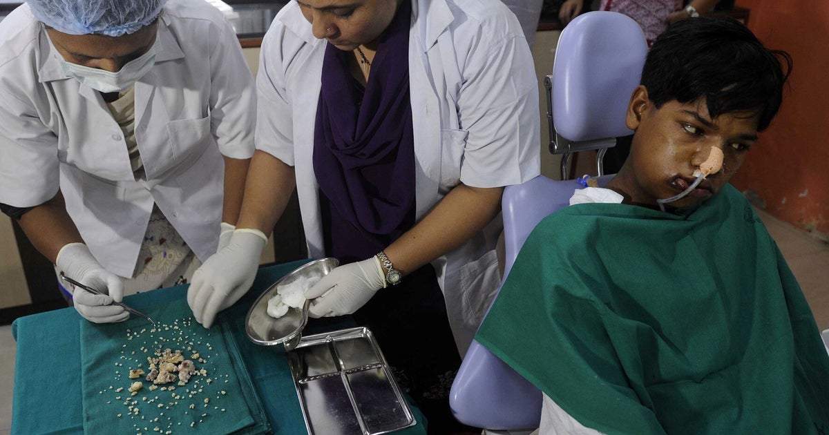 Indian Teenager Ashik Gavai Has 232 Teeth Removed In ‘World Record ...