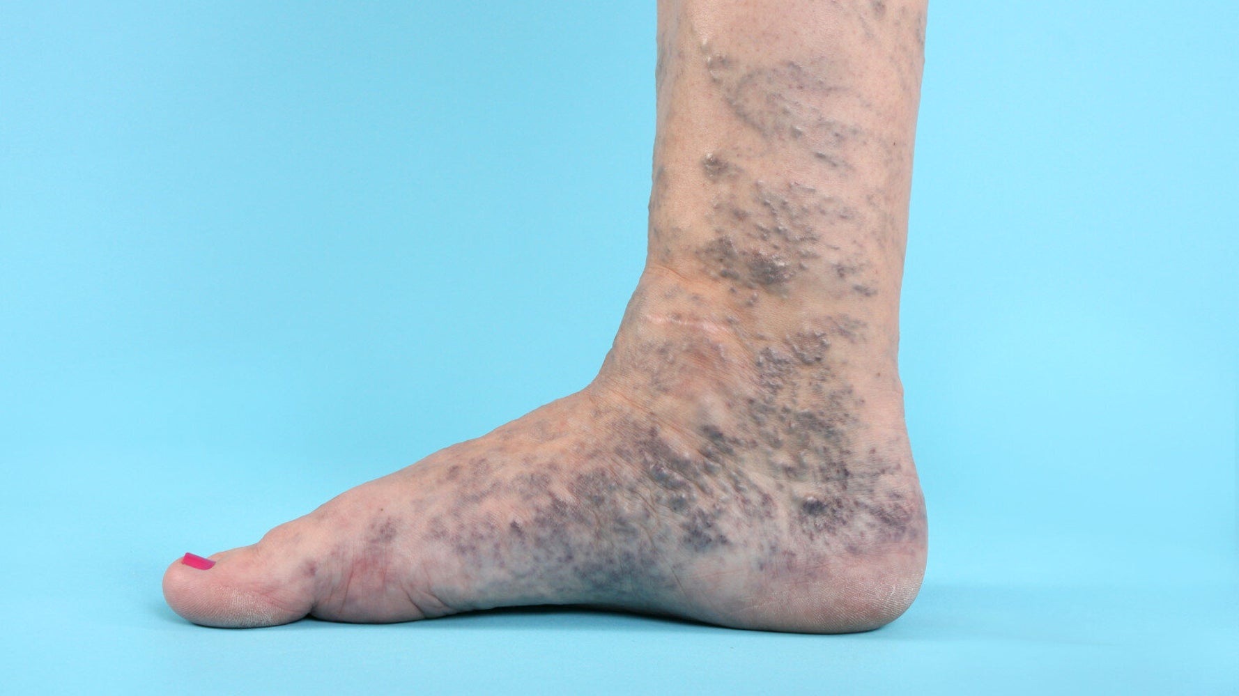 Obesity And Varicose Veins The Hidden Problem Huffpost Uk Life
