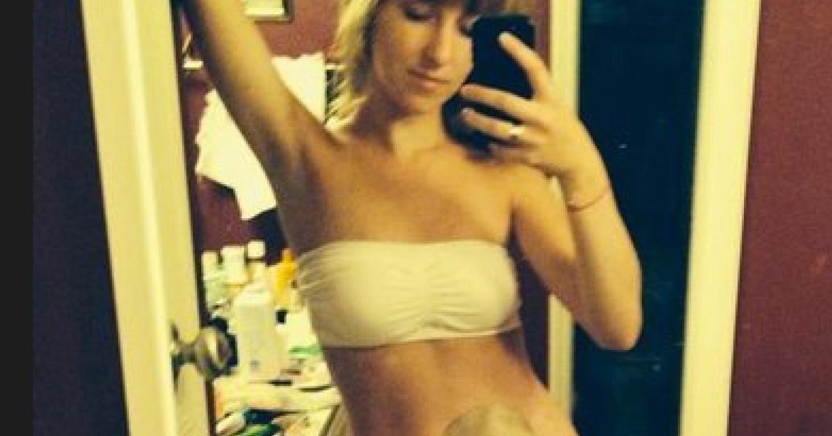 Getyourbellyout People With Colostomy Bags And Scars Proudly Bare