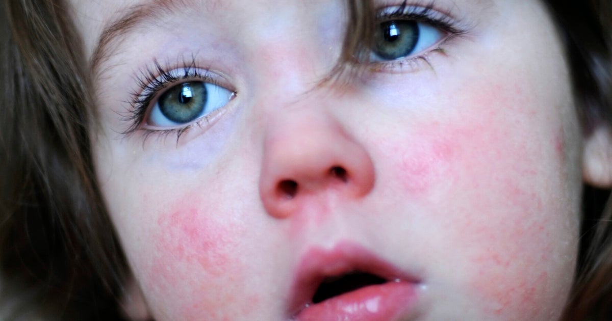 Scarlet Fever Cases At 24-Year High: Here's How To Spot The Symptoms ...