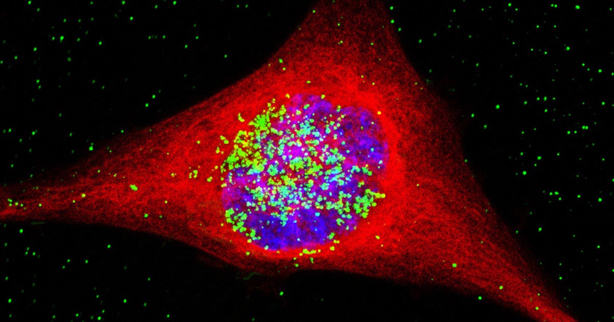 Gold Particles 'Could Kill Brain Cancer Tumour Cells', Study Finds ...