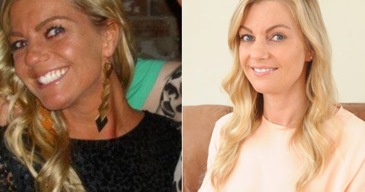 'Tanorexic' Mum Who Had A Cancerous 'Rodent Ulcer' Warns Against ...