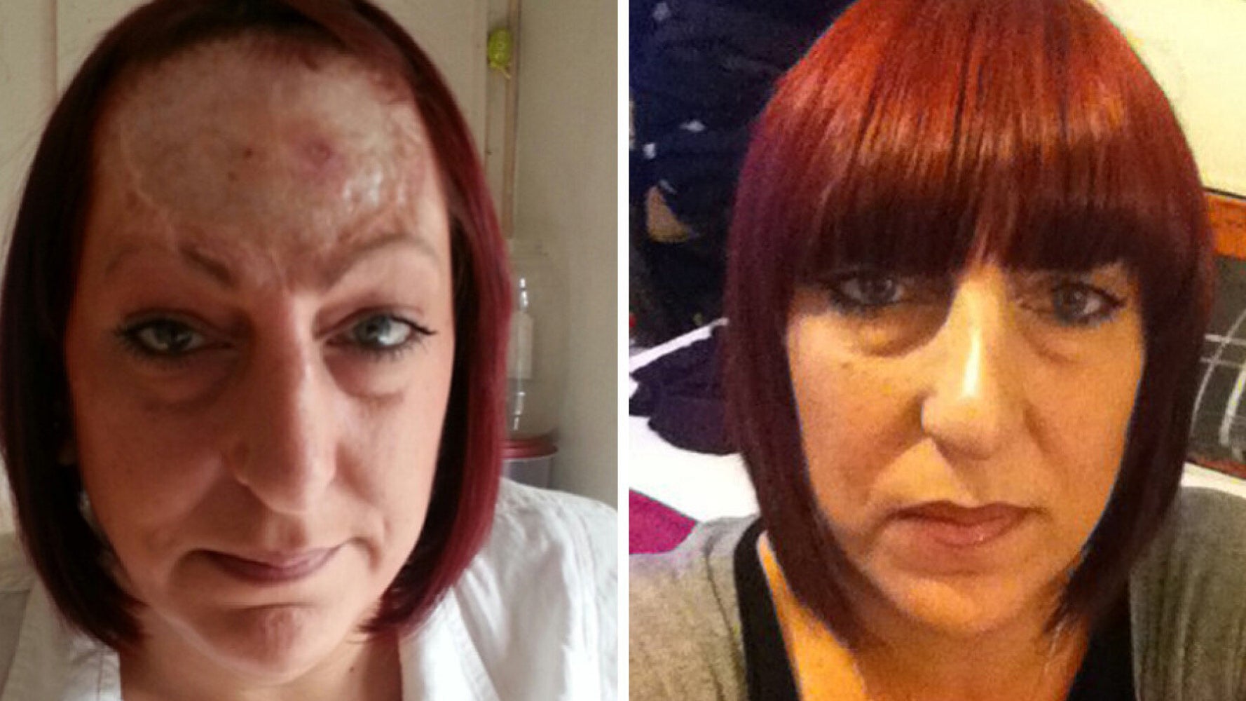 Woman Left With No Forehead After Rare Cancer Forces Doctors To Remove ...