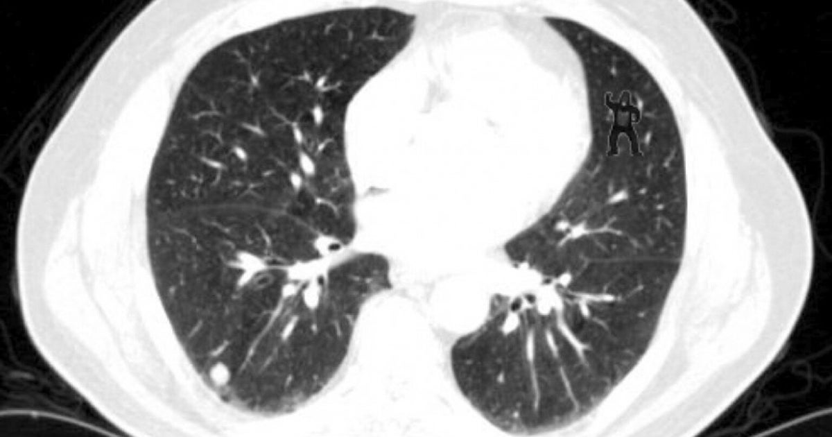 Dancing Gorilla: Psychological Study Shows 83% Of Radiologists Couldn't ...