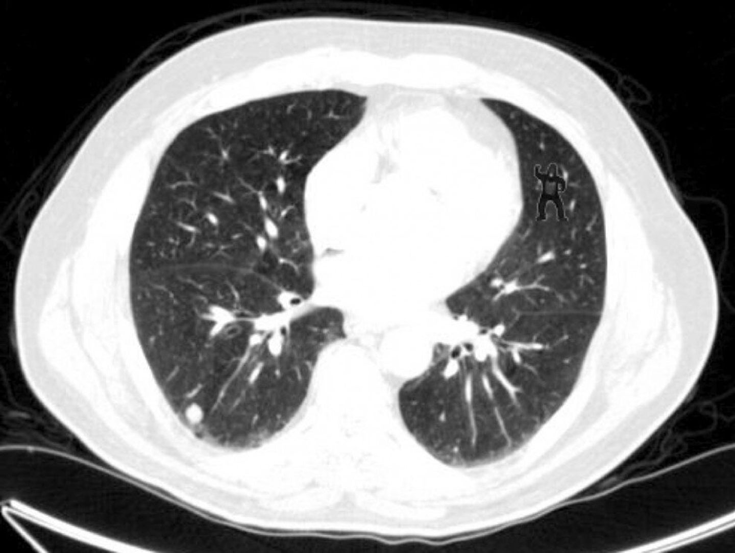 Dancing Gorilla: Psychological Study Shows 83% Of Radiologists Couldn't ...