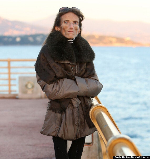 Anorexia Sufferer, Valeria Levitin, 'The World's Thinnest Woman' Shocked At Being 'Role Model ...