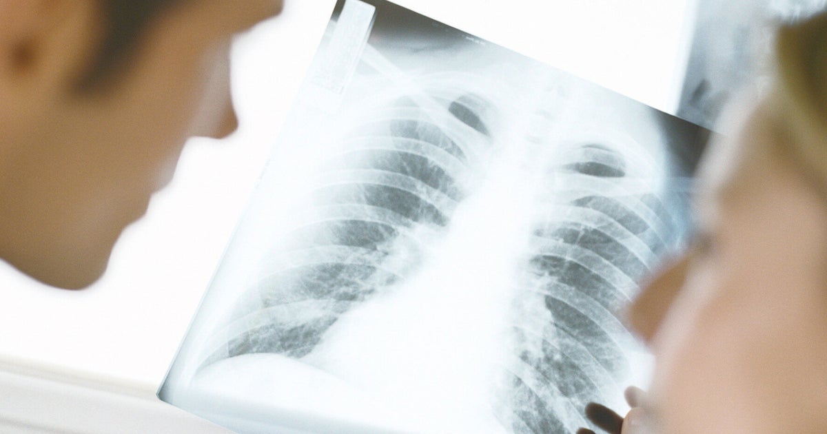 Living With The Terminal Lung Condition You've Never Heard Of ...