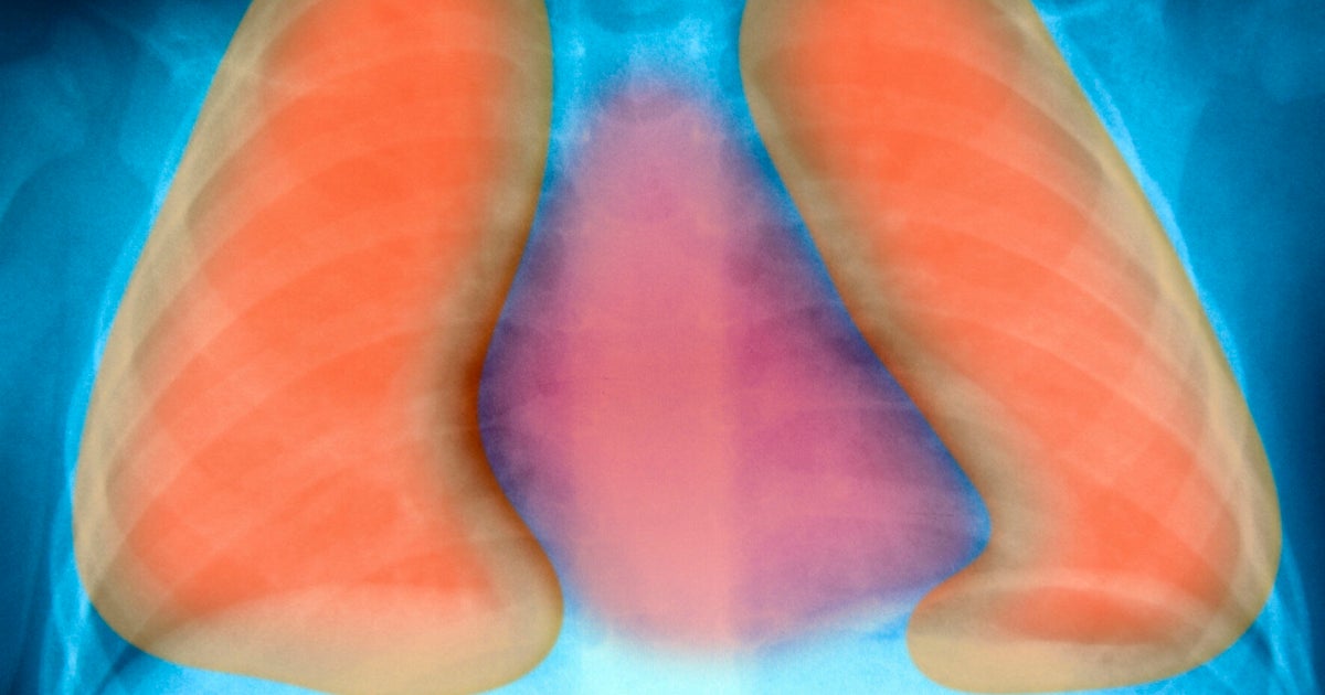 How I Was Inspired To Fight IPF | HuffPost UK Life