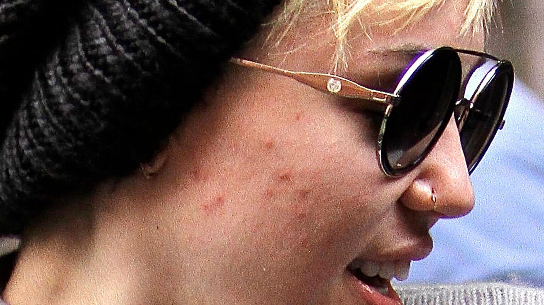 Miley Cyrus Heads To Skin Clinc After Suffering Outbreak Of Spots (PICS ...