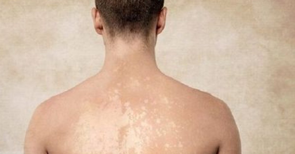 Des taches après le soleil? C'est peut-être à cause du «champignon de l ...