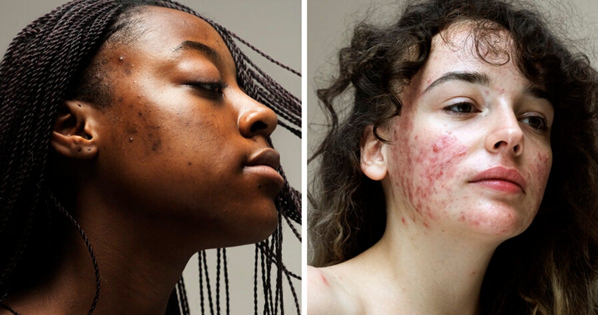 This Powerful Photo Series Celebrates 'Real Skin' In All Its Glory ...