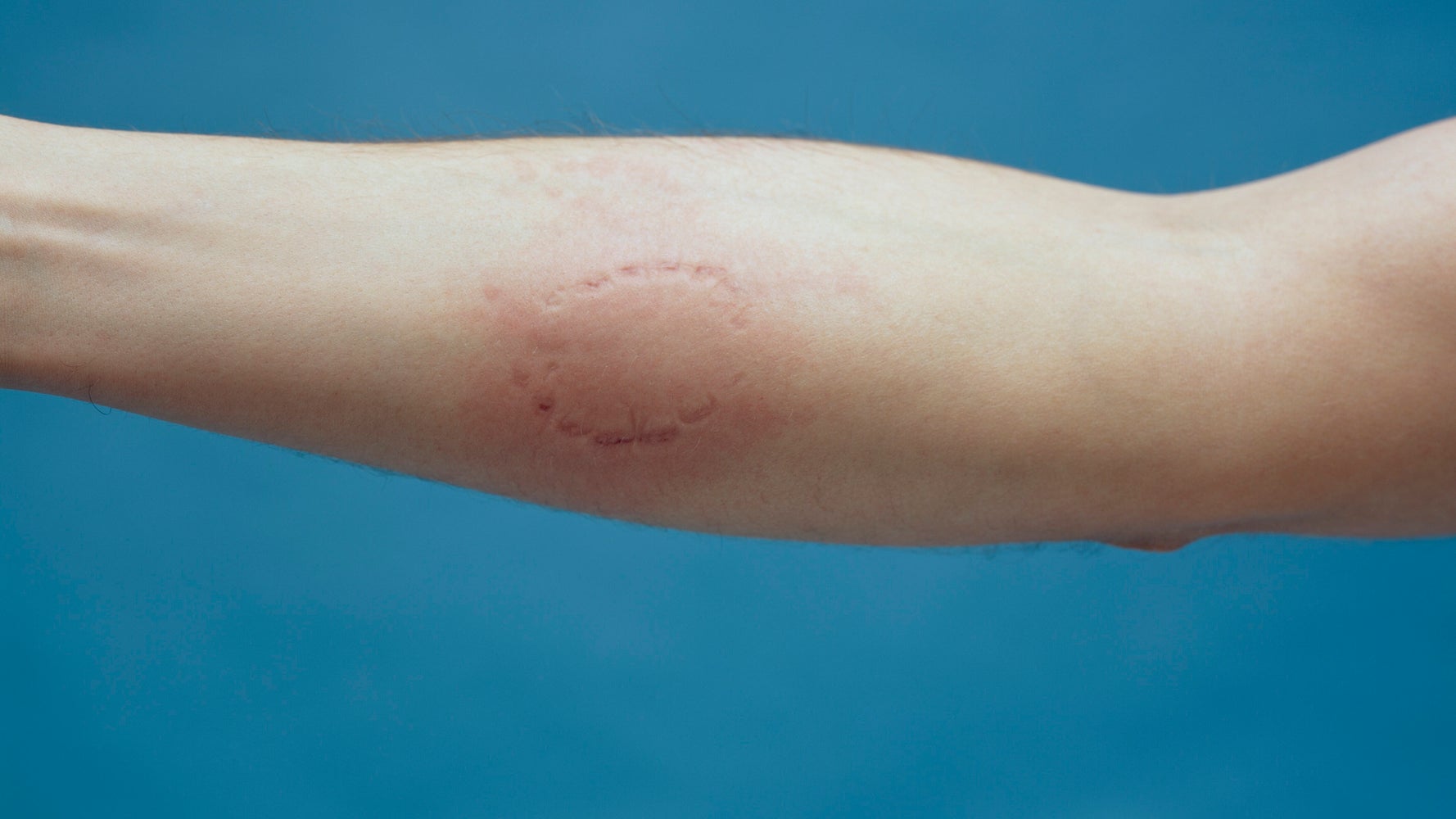 My Son Was Bitten At Nursery, Twice – What Every Parent Needs To Know ...