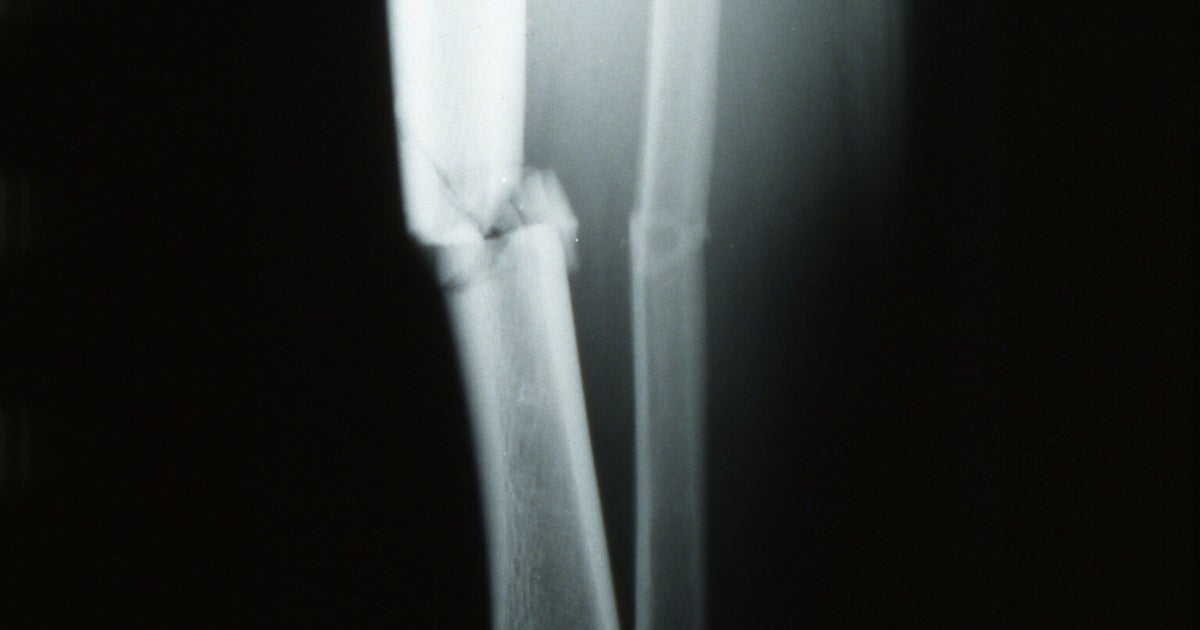 Ultrasound Treatment To Heal Bone Fractures Approved By NHS | HuffPost ...