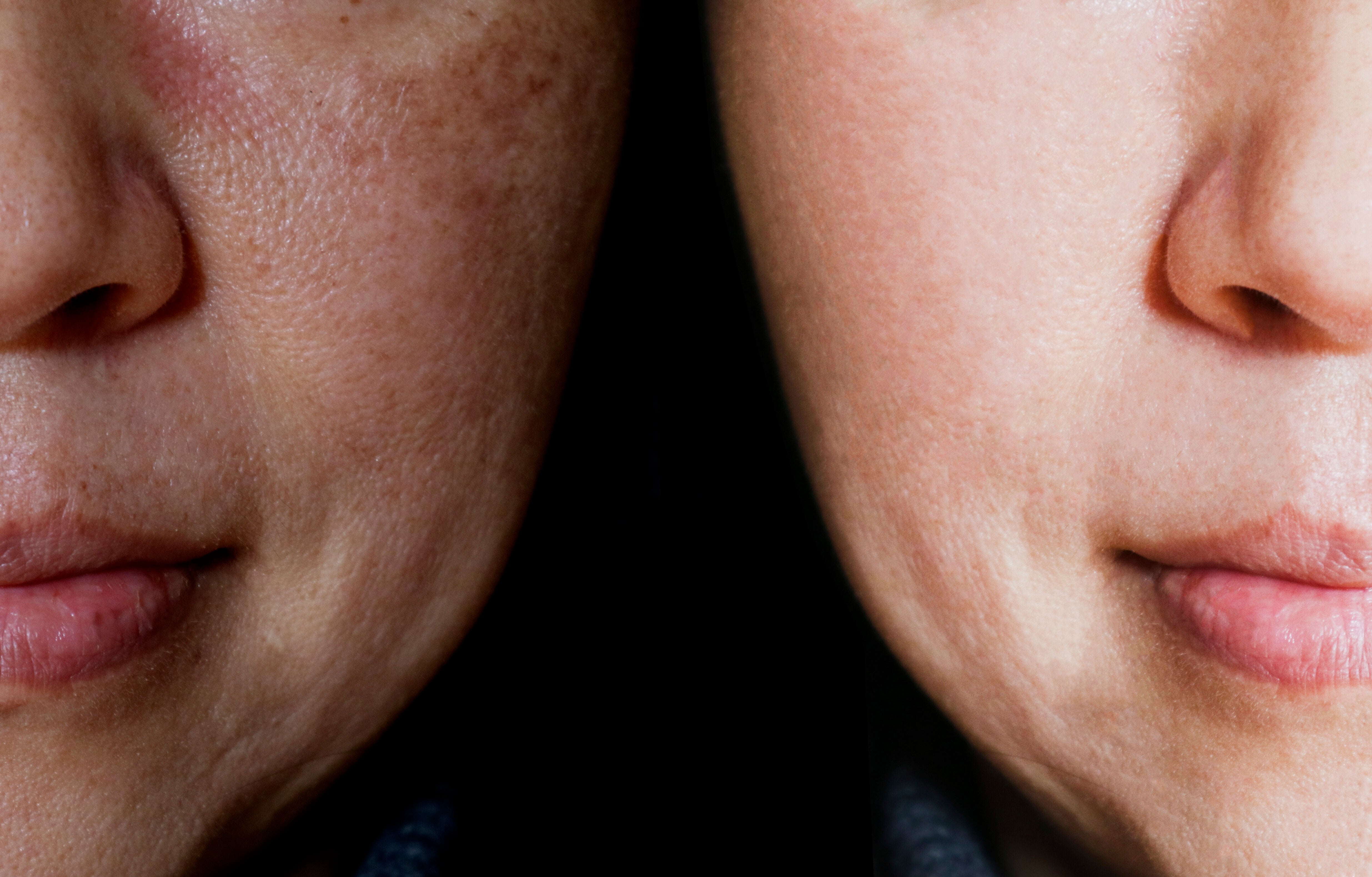 How To Treat The 5 Most Common Postpartum Skin Conditions HuffPost Life How To Treat The 5 Most Common Postpartum Skin Conditions HuffPost Life