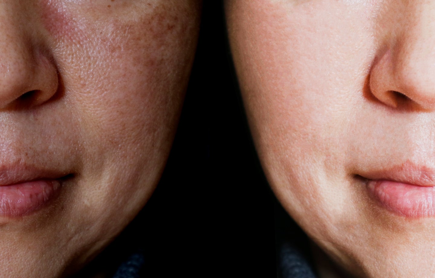 How To Treat The 5 Most Common Postpartum Skin Conditions | HuffPost Life