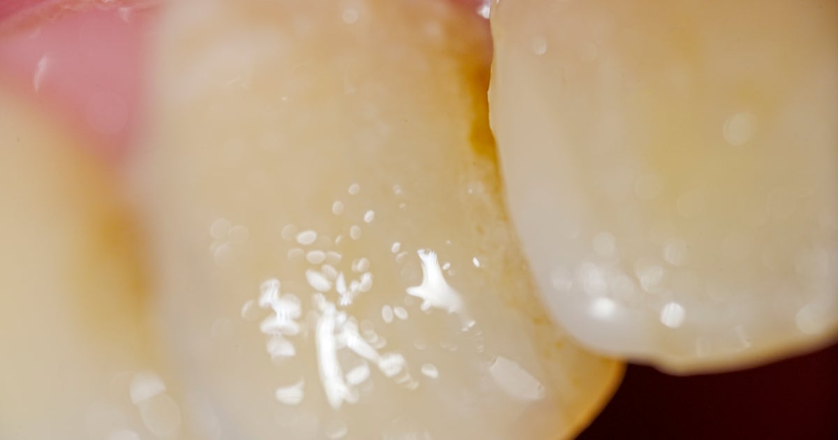Why Do I Have Cavities Even Though I Look After My Teeth? | HuffPost UK ...