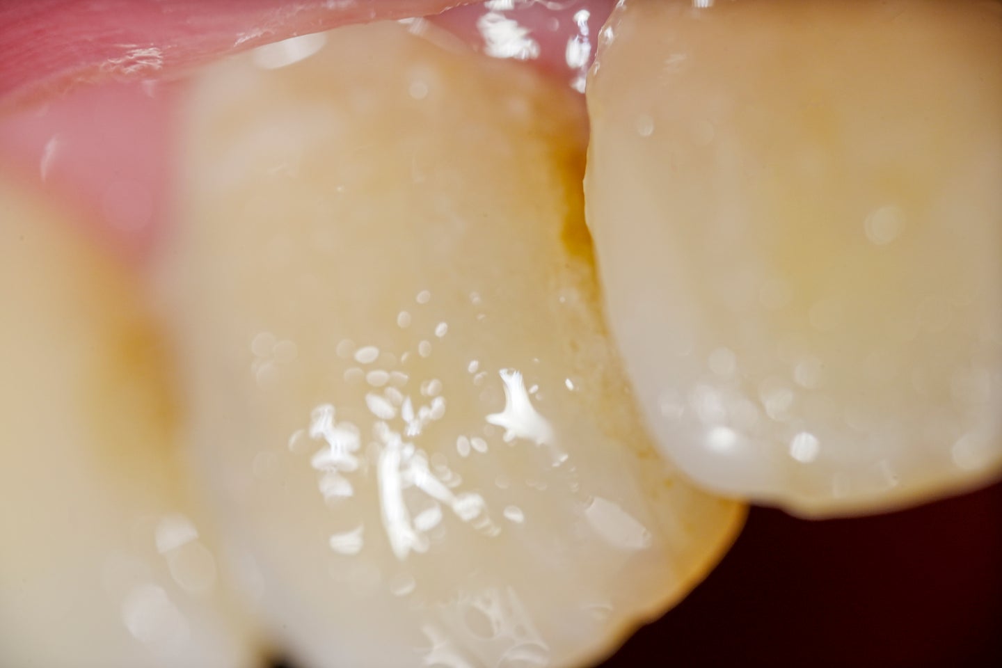 Why Do I Have Cavities Even Though I Look After My Teeth? | HuffPost UK ...