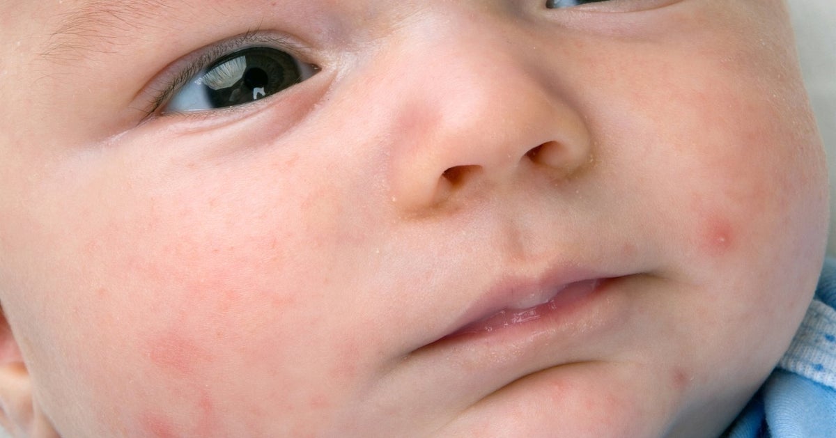 Baby Rashes Decoded: When Do You Need To Worry And What’s Normal ...
