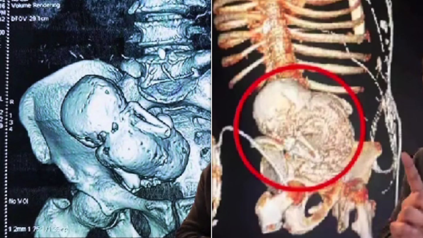 Yes, 'Stone Babies' Are Real ― Here's How They Happen | HuffPost UK Life