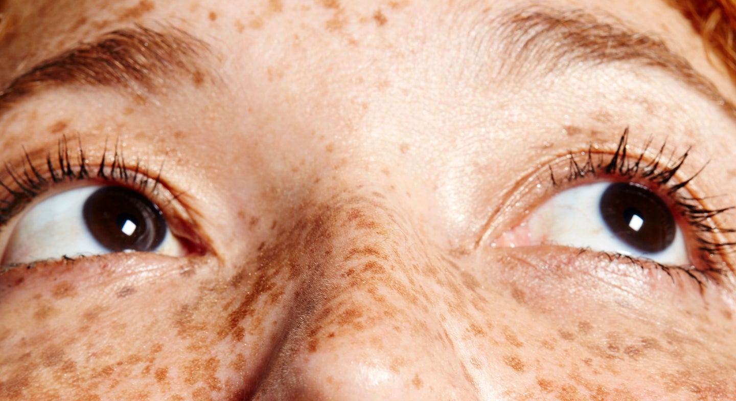 Freckles Are 'In' Now — And People Who Grew Up Hating Theirs Have ...