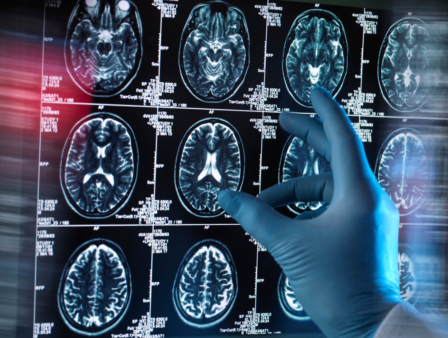 There Are 2 New Dementia Risk Factors You Should Know About | HuffPost Life