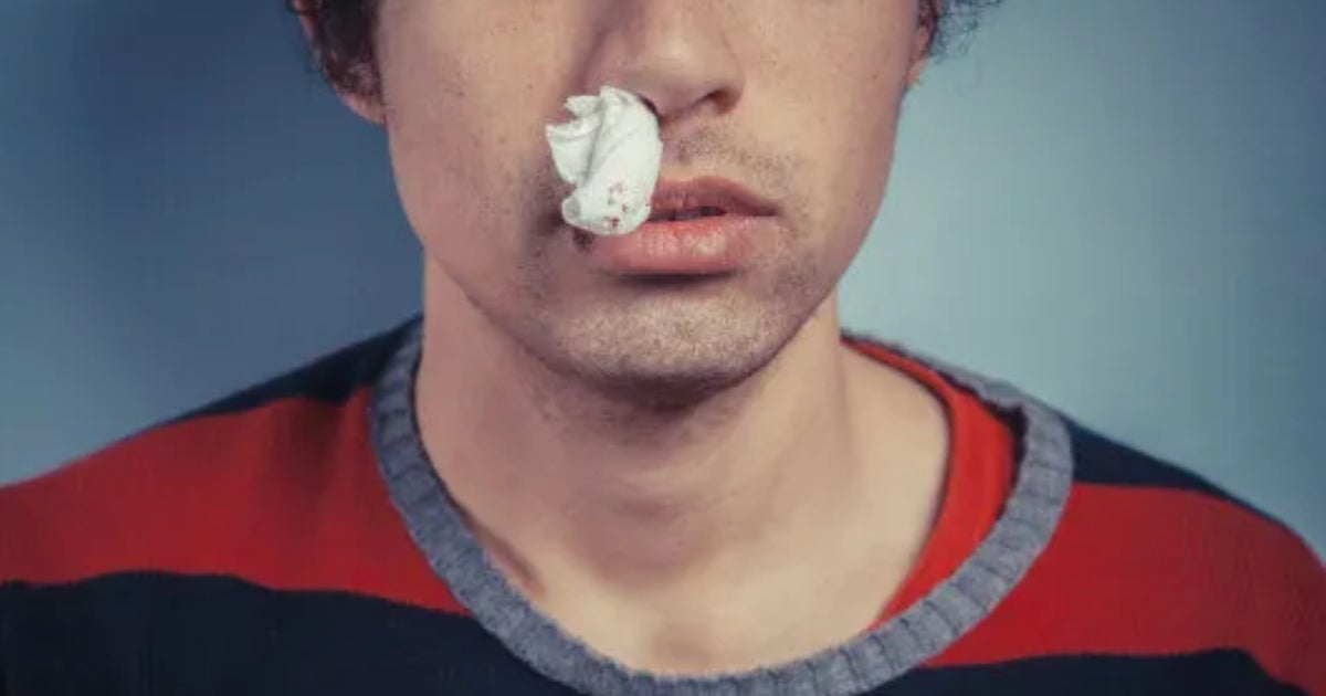 Here's When You Should Worry About A Nosebleed | HuffPost UK Life