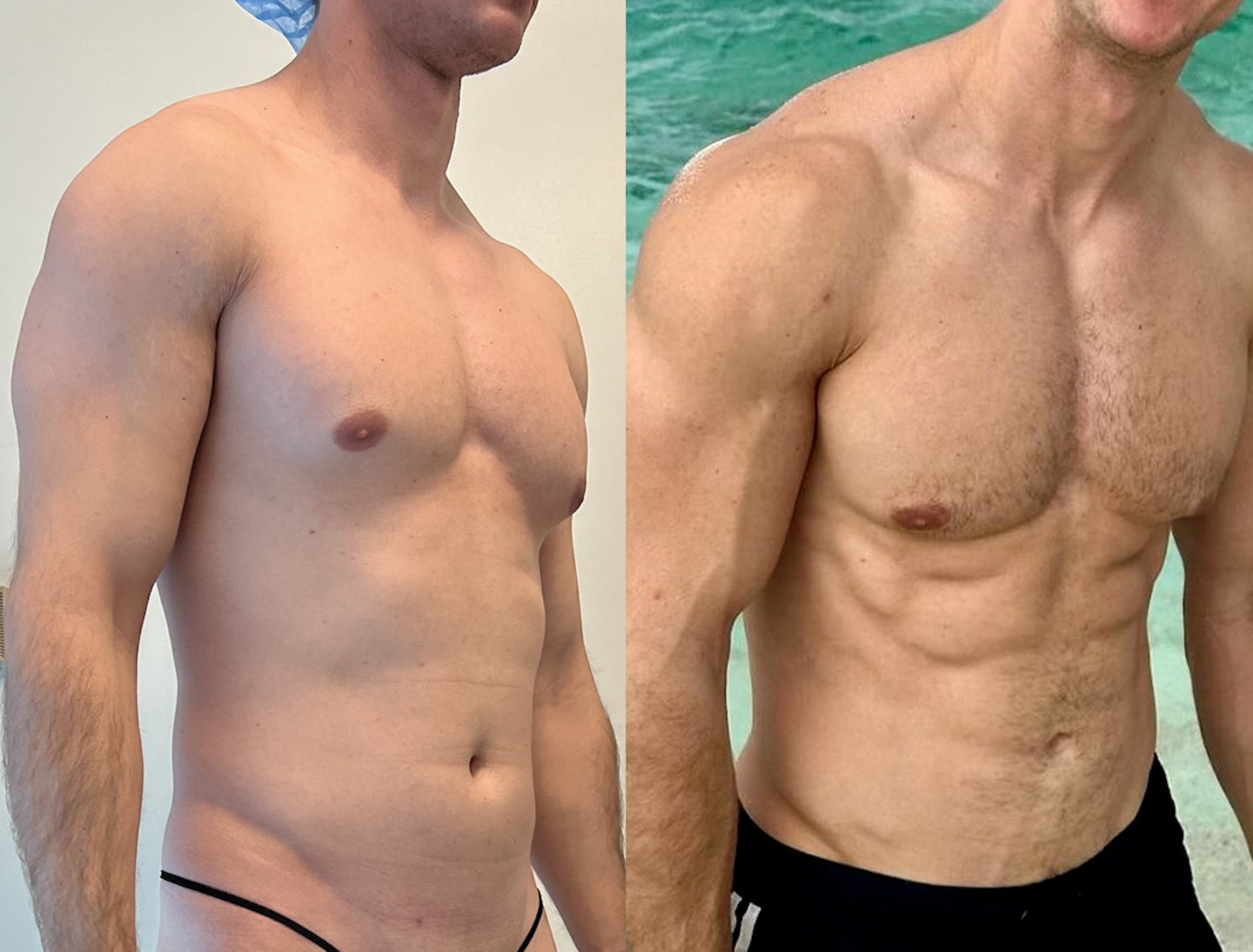 What Is Six-Pack Surgery, Or Ab Etching? | HuffPost Life