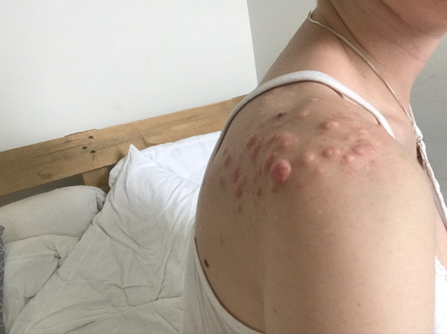 Keloid Acne Vulgaris: Why I’m Done Hiding My Skin Condition | HuffPost ...