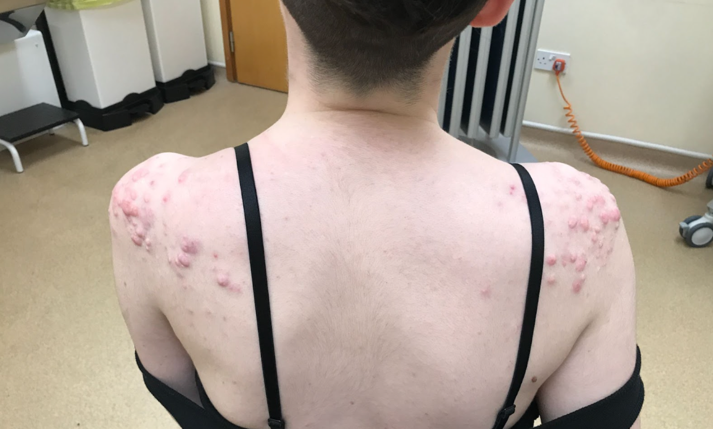 Keloid Acne Vulgaris: Why I’m Done Hiding My Skin Condition | HuffPost ...