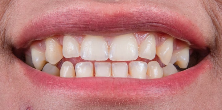 People Are Reporting 'Ozempic Teeth' – But Is It Even Real? | HuffPost ...