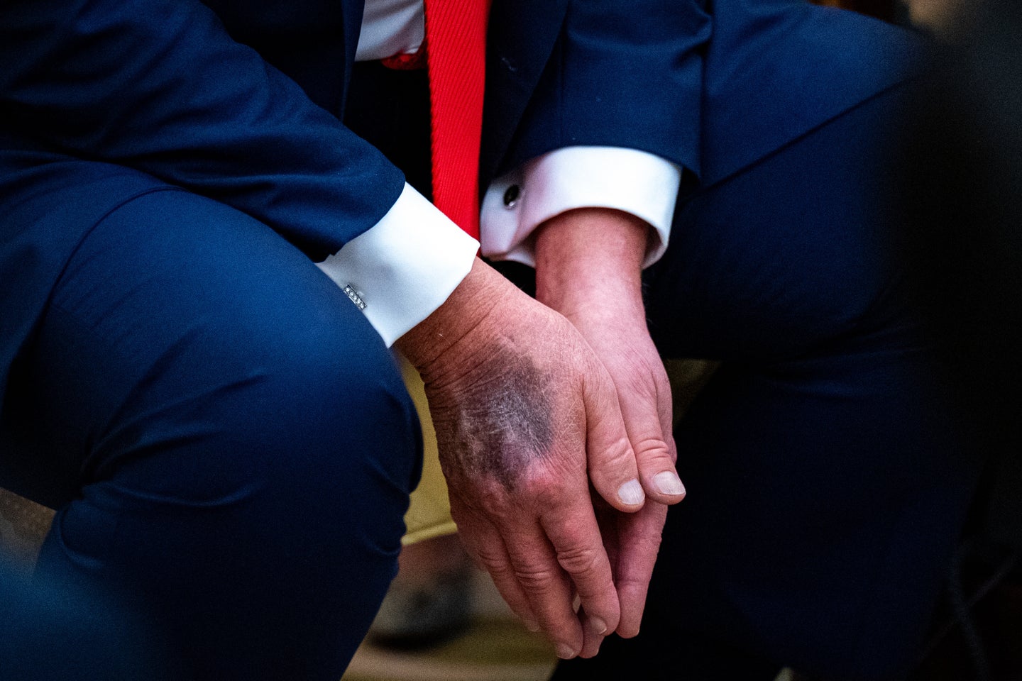 Stephen Colbert Has A Theory About That Bruise On Trump's Hand ...