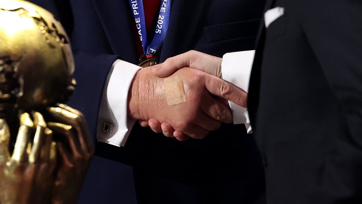 Trump's Bruised Hand Is Looking Pretty Swollen | HuffPost Latest News